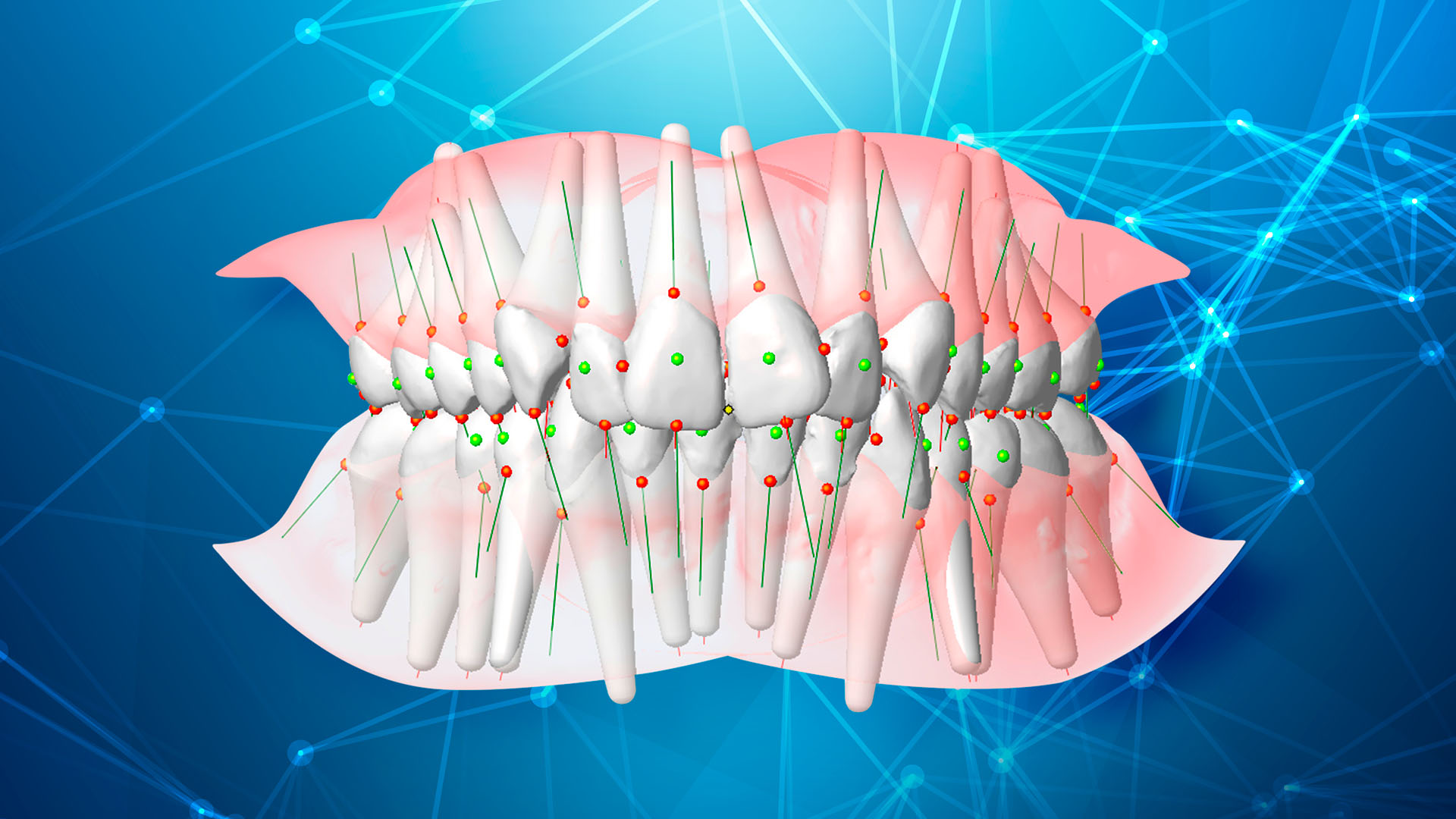 ClearSplint® - Excent Tandtechniek