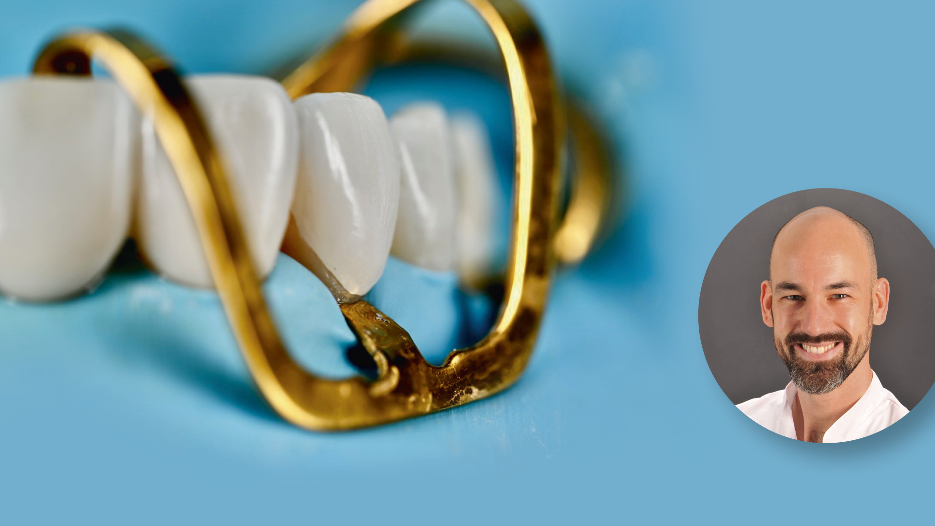 Hands-on Workshop - Porseleinen facings: theorie & praktijk